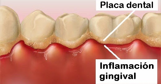 Odontología Integral: PLACA DENTOBACTERIANA